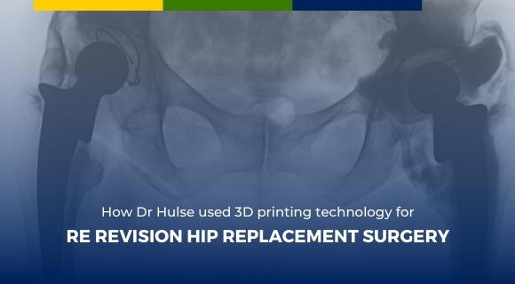 Hip Revision Surgery Using 3D Technology - Dr Narayan Hulse