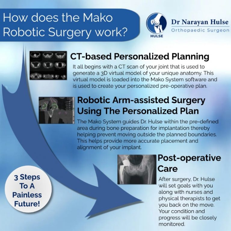 How Does Mako Robotics Surgery Work? – WDXO
