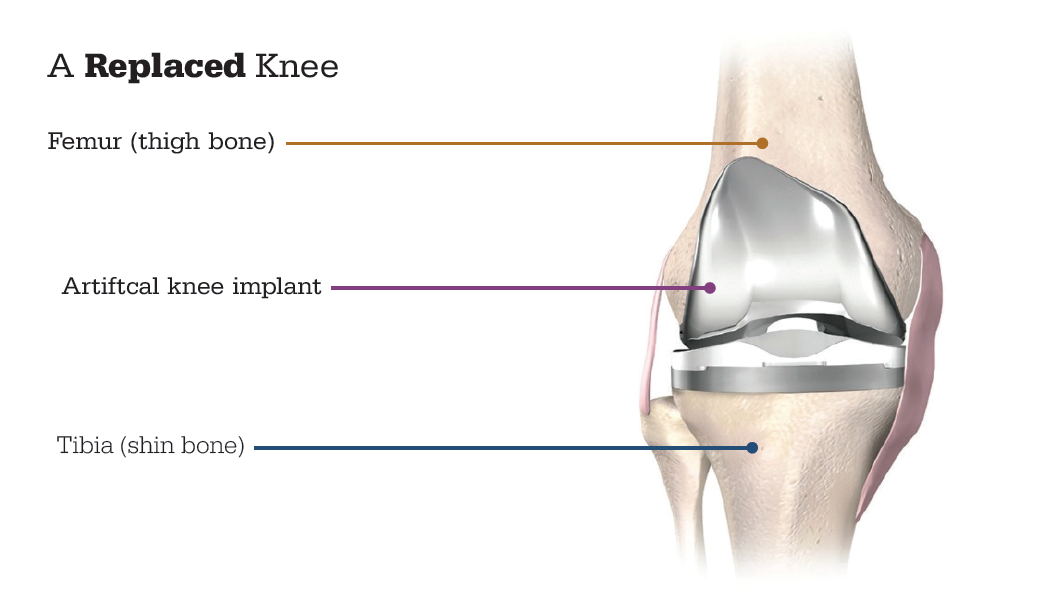 Mako Robotic Total Knee Replacement Dr Hulse Mako Robotic Total Knee Replacement Dr Hulse