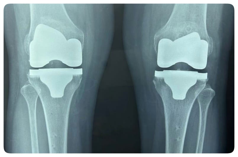 Get Your Total Knee Replacement Surgery - Dr Narayan Hulse